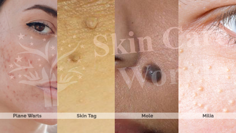 Skin Growths Treatment in Gurgaon