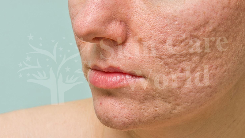 Open Pores Treatment in Gurgaon